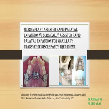 Microimplant assisted rapid palatal expansion vs surgically assisted ...