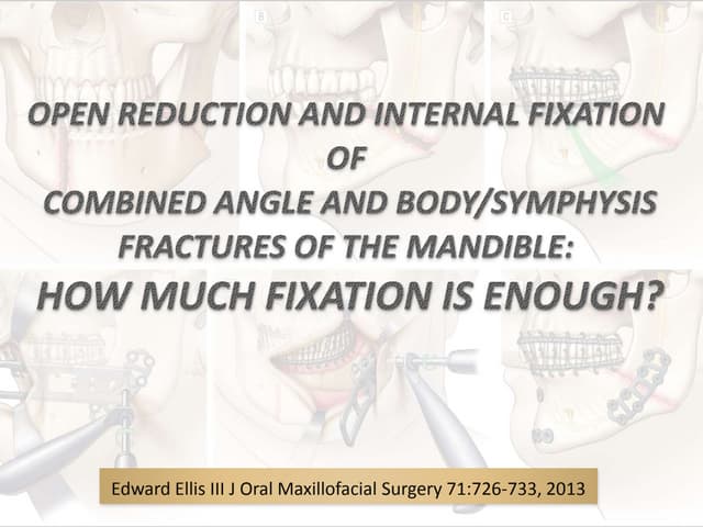 Fracture mandibular angle | PPSX