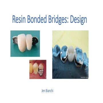 Resin Bonded Bridges | PPTX
