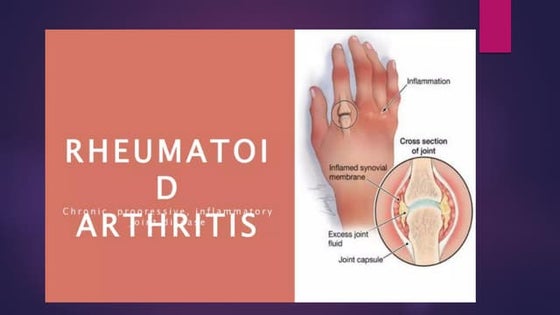 Osteoarthritis | PPTX