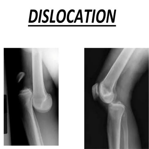 joint dislocations.pdfyyyyyyyyyyyyyyyyyyy | PDF