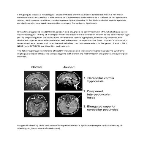 Joubert's syndrome | PDF