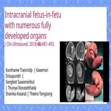 A fetus in fetu (FIF), also known as an inclusion fetus or parasitic ...