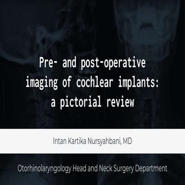 Pre post operative imaging of cochlear implant.pptx