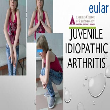Juvenile idiopathic arthritis | PPTX