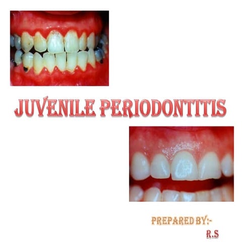 Juvenile periodontitis | PPT