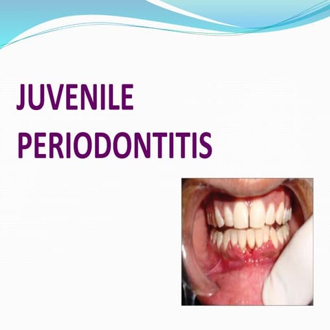 Juvenile Periodontitis | PPTX