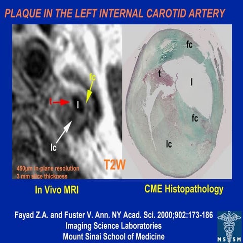 081 carotid artery plaque | PPT