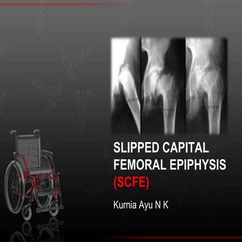 SCFE / slipped capital femoral epiphysis | PPTX