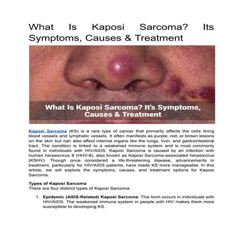 What Is Kaposi Sarcoma? Its Symptoms, Causes & Treatment | PDF