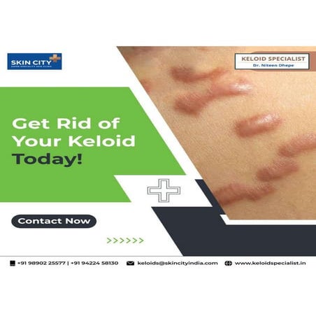 Keloid Specialist in Pune | PDF