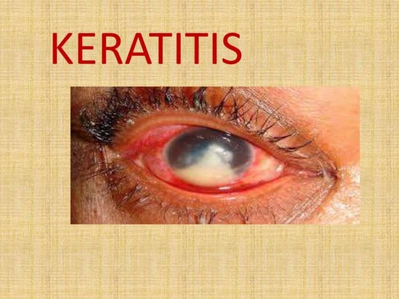 Disorders of the eye | PPT