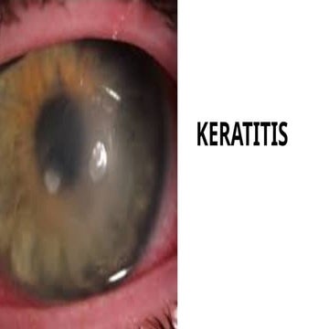 keratitis and keratoplasty causes and management.pptx