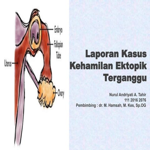 Laporan Kasus Kehamilan Ektopik Terganggu.pptx