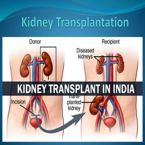 Kidney transplantation | PPTX