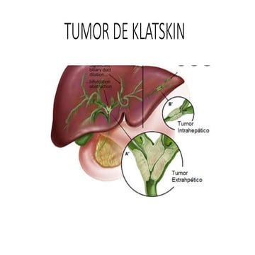 NEOPLASIA MUCINOSA QUÍSTICA HEPÁTICA Radiology | PPTX