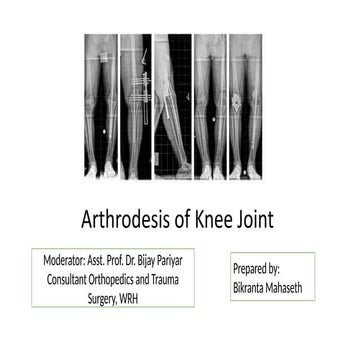 Knee arthrodesis.pptx position of arthodesis | PPTX