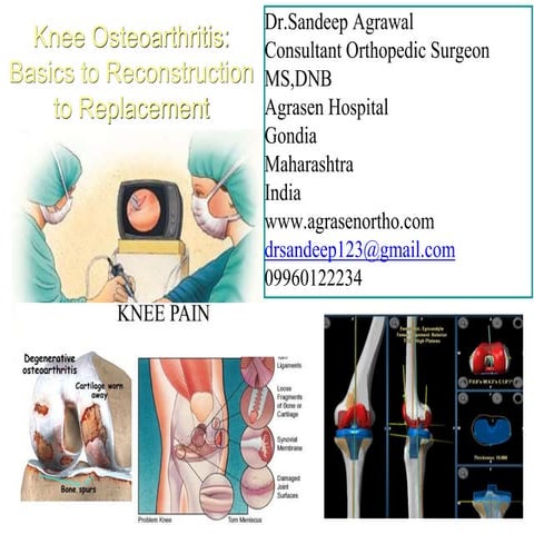 Knee osteoarthritis basics to reconstruction to replacement dr.sandeep ...