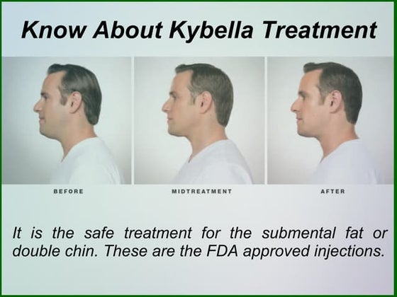 What is Kybella? | PPT