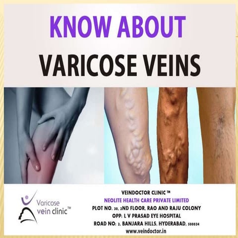 Know about varicose veins | Best Treatment for Varicose Veins | PPTX