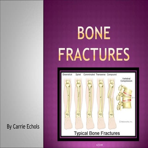 Bone Fractures | PPT