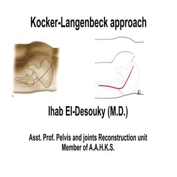 Kocher-Langenbeck acetabular approach | PPTX