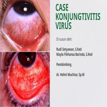 KONJUNGTIVITIS VIRAL PRESENTASI STASE MATA | PPTX