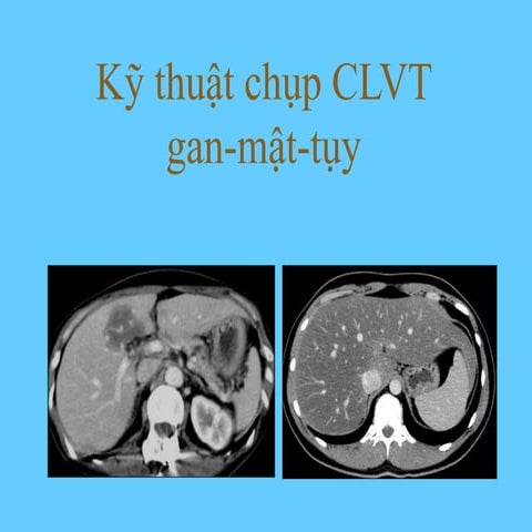 Giải phẫu cột sống và hình ảnh chấn thương cột sống trên clvt | PPT