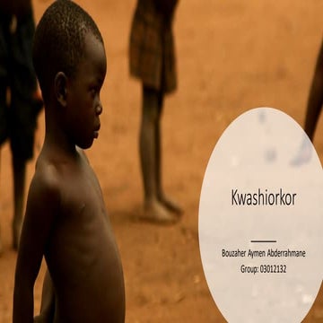 Kwarshirkor Presentation by BOUZAHER AYMEN ABDERRAHMANE | PDF