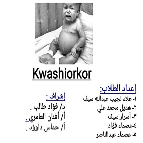kwashiorkor disease .pdf