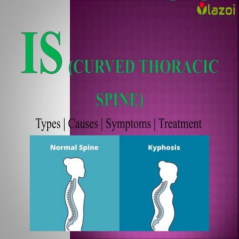 Kyphosis.pptx