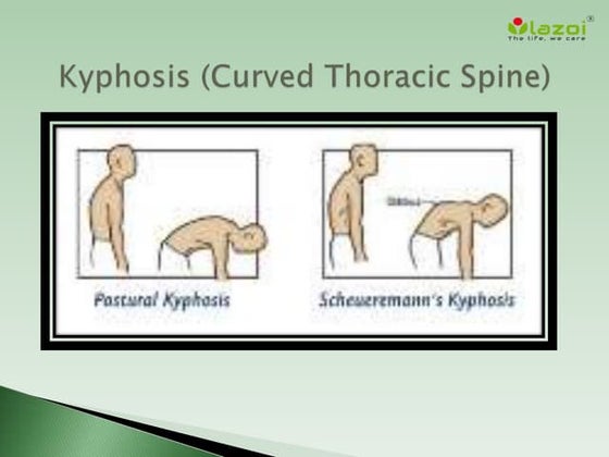 Arthritis Causes Symptoms Treatment And Prevention Pptx Bone