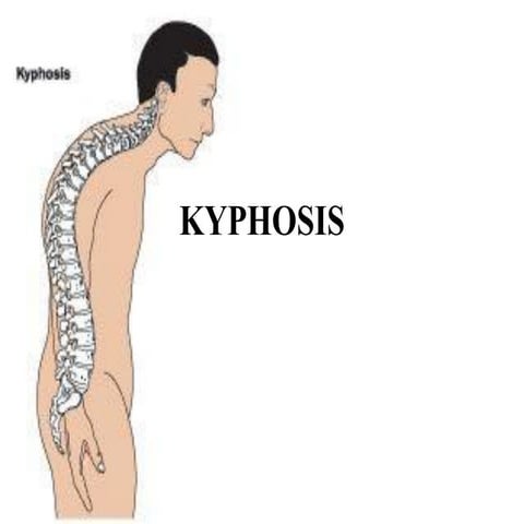 KYPHOSIS LORDOSIS.pdf