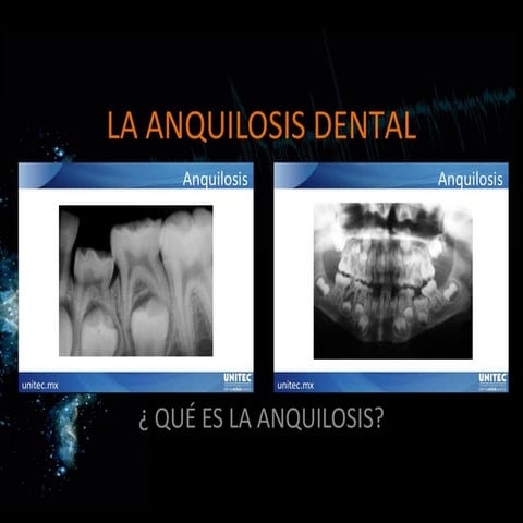 La anquilosis dental | ODP