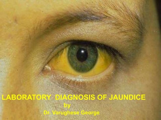 3jaundice.pptx related to liver diseases | PPT