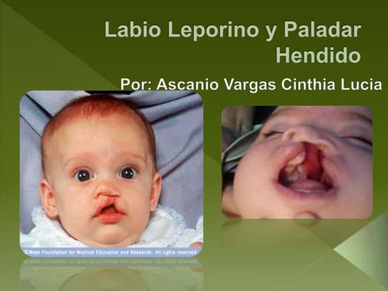 Cleft lip and cleft palate | PPTX