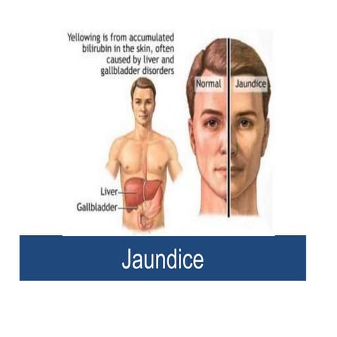 Laboratory approach to jaundice | PPTX