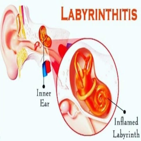 labyrinthitis-OM.pdf