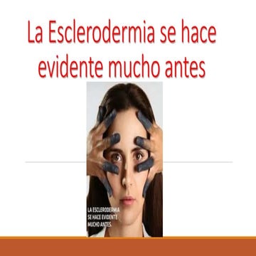 La esclerodermia se hace evidente mucho antes | PPTX