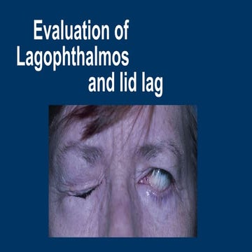 Lagophthalmos.ppt | Ear, Nose and Throat Conditions | Diseases and ...