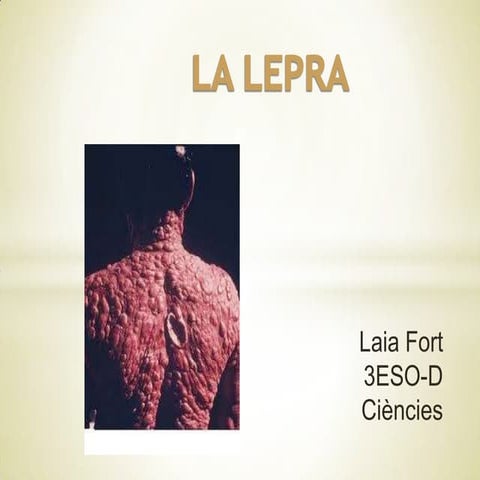 La lepra | PPTX