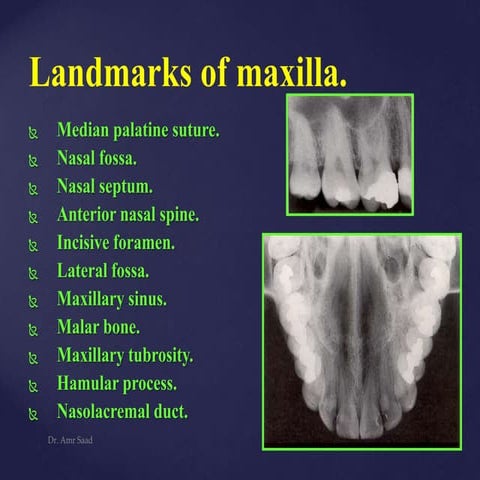 Maxillary Tuberosity Radiograph
