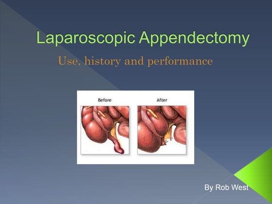 Open appendectomy | PPT