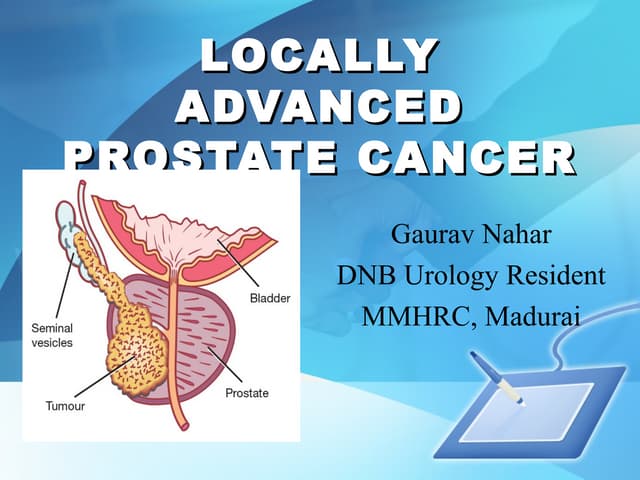 Locally Advanced Prostate Cancer Ppt