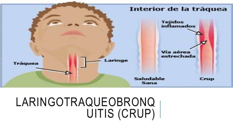 Laringotraqueobronquitis (crup)