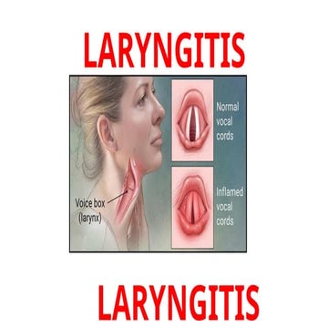 Laryngitis | PDF