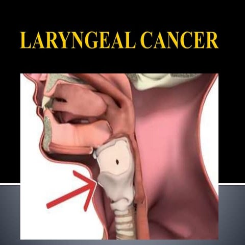 Larynx cancer.pptx