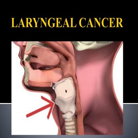 Larynx cancer.pptx
