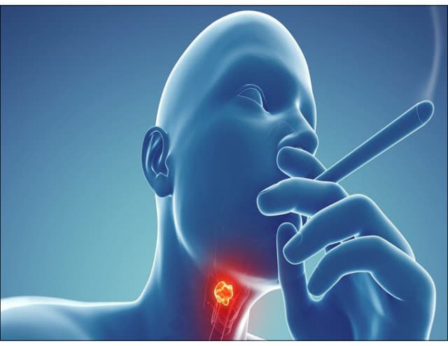Cancer of larynx and laryngeal cancer ppt | PPTX