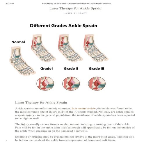 Ankle Sprain Grades